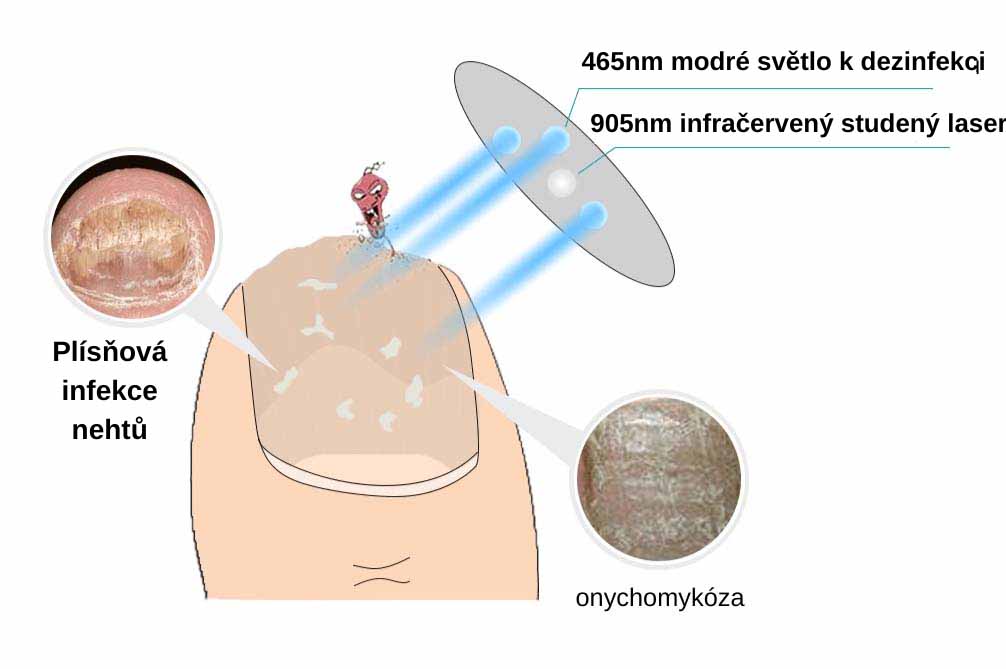 LUNILASER Laserový přístroj pro zdravé nehty
